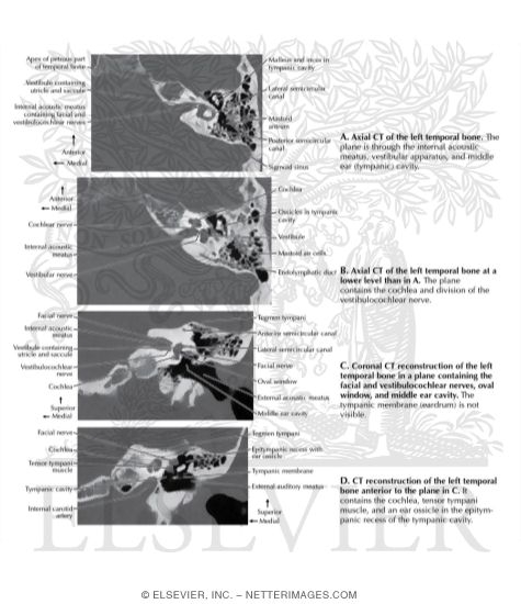 temporal bone labeled ct
