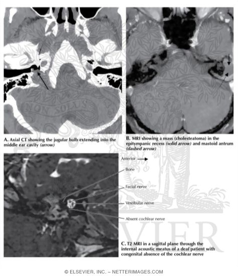 Imaging of Temporal Bone/Ear Pathology