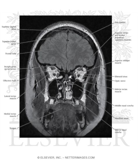T2 FLAIR Coronal MRI Through the Frontal Lobes