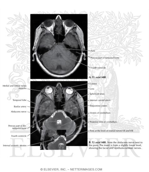 T1 and T2 Axial MRI Through the Cerebellum, Temporal Lobes, and Eye