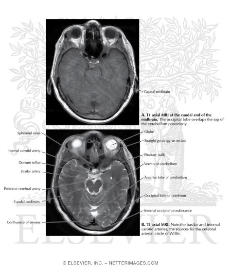 Internal Occipital Protuberance Mri