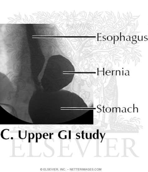 Upper GI Study