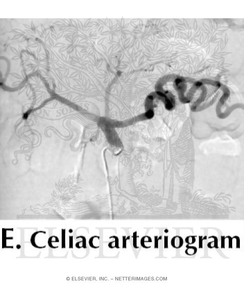 Celiac Arteriogram