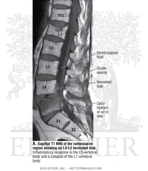 Sagittal T1 MRI of the Lumbosacral Region Showing an L4-L5 Herniated Disk