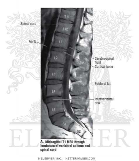 Lumbar Spine Mri Labeled