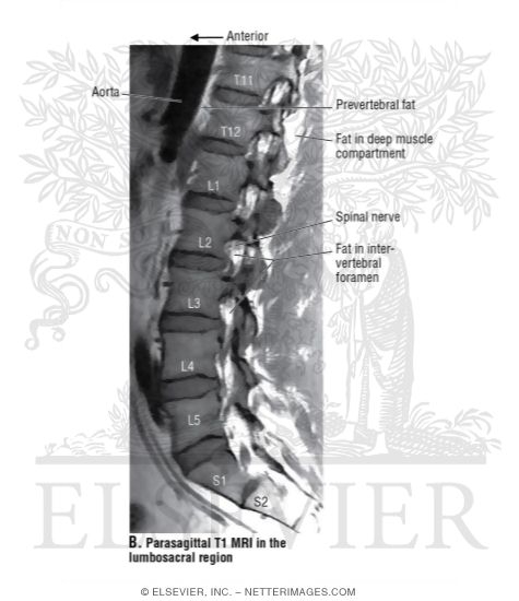 Parasagittal T1 MRI In the Lumbosacral Region
