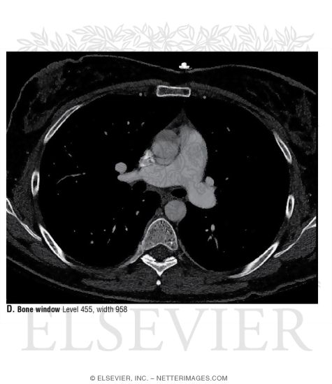 Bone Window: Level 455
