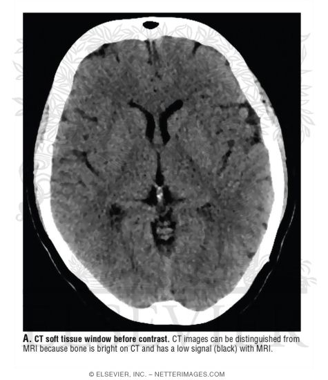 CT Soft Tissue Window Before Contrast