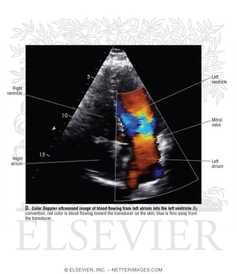 Color Doppler Ultrasound Image of Blood Flowing From Left Atrium Into ...