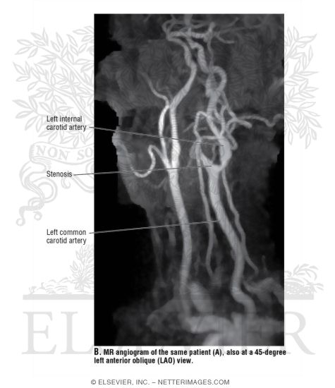 MR Angiogram at a 45-Degree Left Anterior Oblique (LAO) View