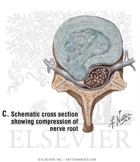 Schematic Cross Section Showing Compression of Nerve Root