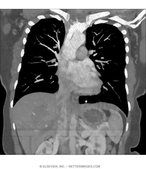 CT Anterior Axillary Coronal Reconstruction With a Mediastinal Window ...