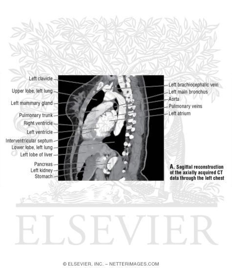 Sagittal Reconstruction of Axially Acquired CT Data Through the Left Chest
