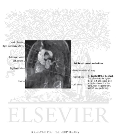 Sagittal MRI of the Chest
