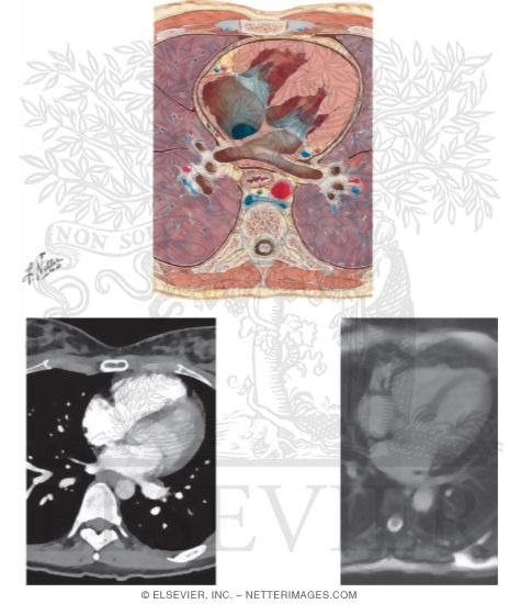 T8 Mediastinum Cross Section With T8 CT and MRI