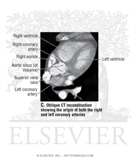 Oblique CT Reconstruction Showing the Origin of Both the Right and Left ...