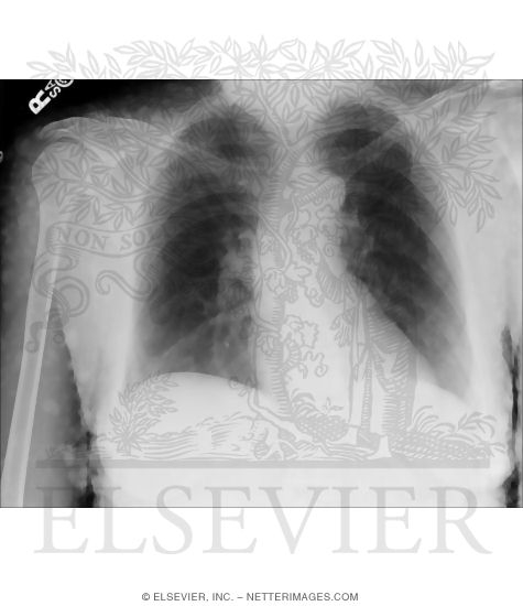Search Strategy: Thoracic Wall Soft Tissues (e.g., Air, Calcification ...