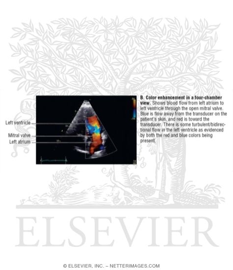 Color Enhancement In a Four-Chamber View