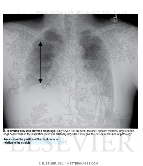 Expiration View With Elevated Diaphragm
