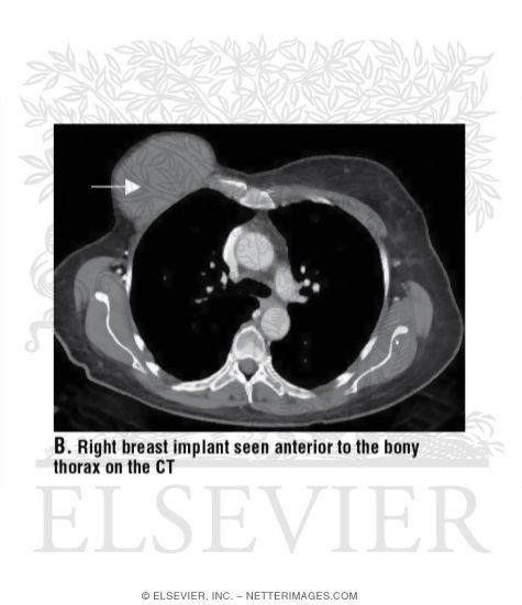 Search Strategy: Thoracic Wall Soft Tissues (e.g., Air, Calcification ...