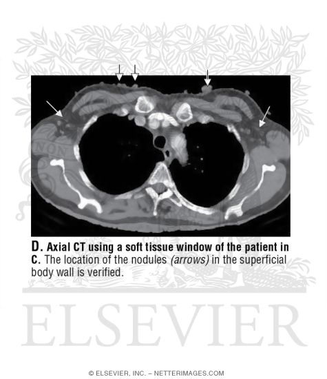 Search Strategy: Thoracic Wall Soft Tissues (e.g., Air, Calcification ...