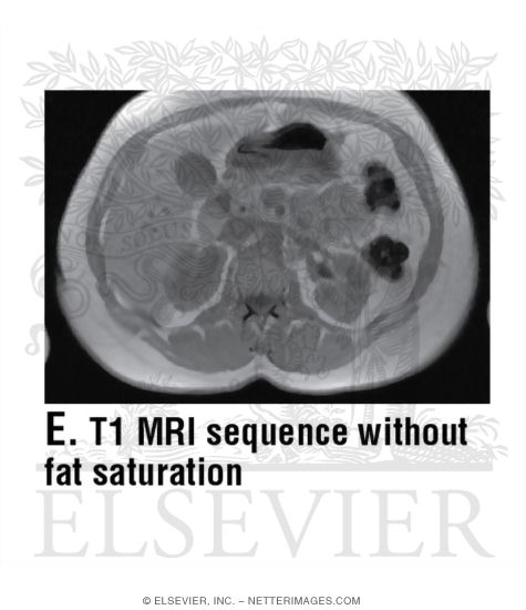 CT Vs. MRI In Abdominal Studies
