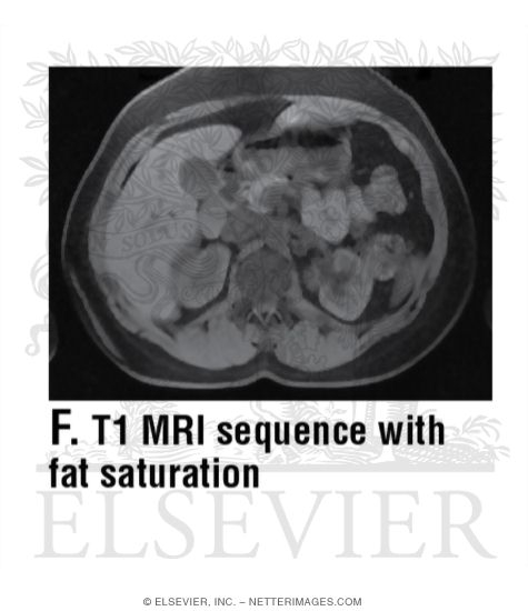 CT Vs. MRI In Abdominal Studies