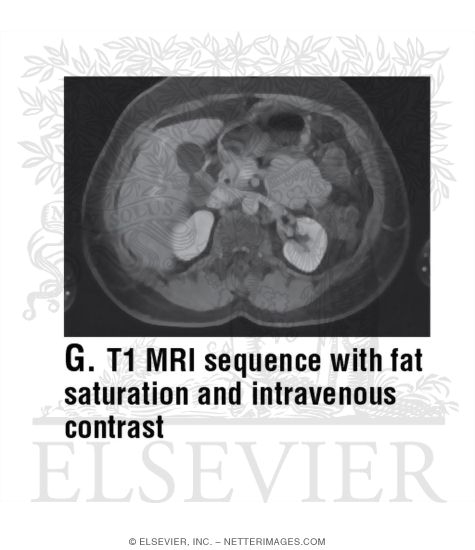 CT Vs. MRI In Abdominal Studies