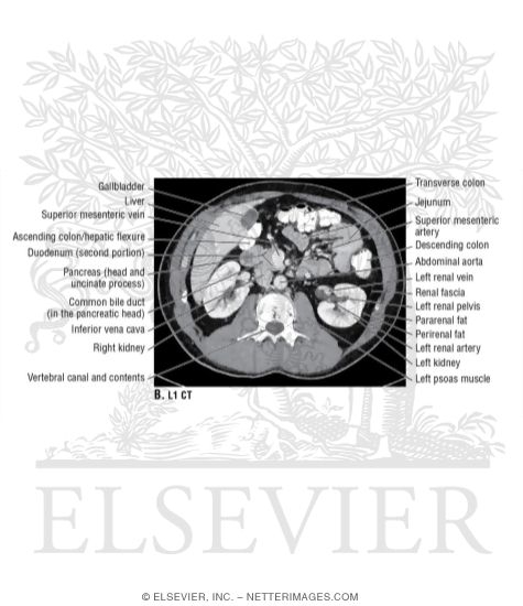 Cross Section at L1-L2 With CT