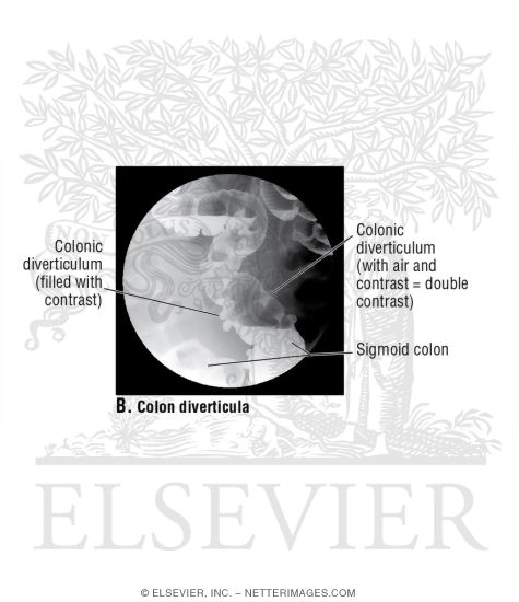 Large Intestine Imaging Studies