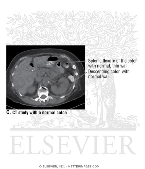 Large Intestine Imaging Studies