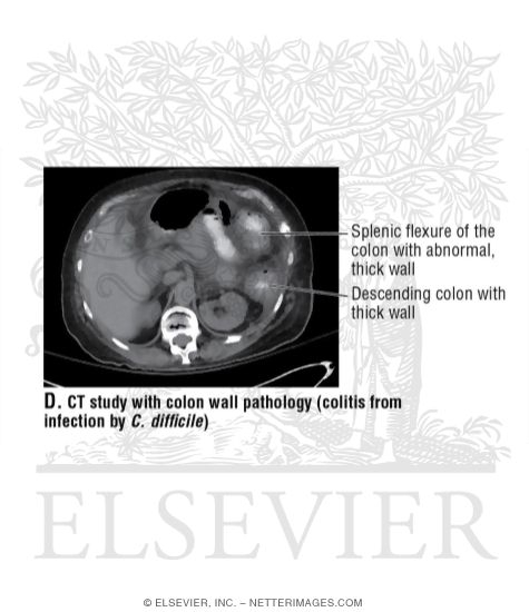Large Intestine Imaging Studies