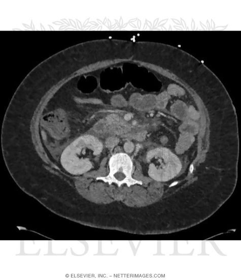 Retroperitoneal Fluid (Darker Gray) Around the Head of the Pancreas and ...
