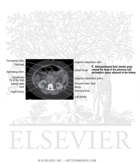 Retroperitoneal Fluid (Darker Gray) Around the Head of the Pancreas and ...