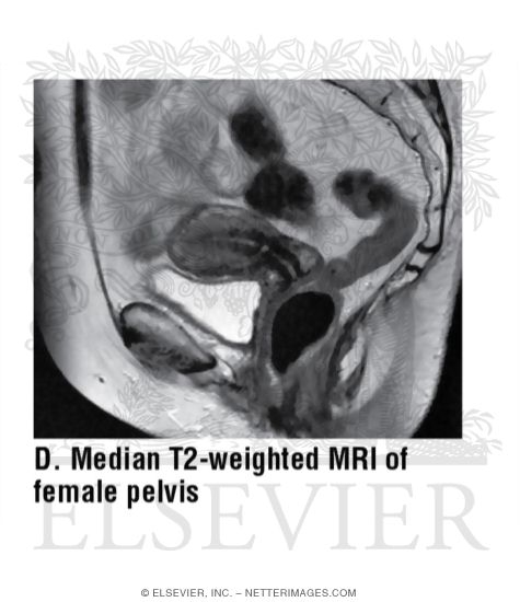Median T2-Weighted MRI of Female Pelvis