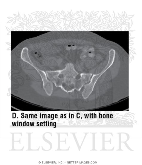 Axial CT With Soft Tissue Setting at Level of S1-S2 With Bone Window ...