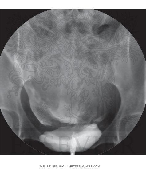 Cystogram Showing Leak In Bladder