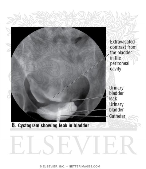 Cystogram Showing Leak In Bladder