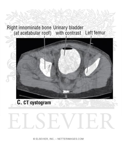 CT Cystogram