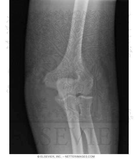 Anteroposterior (AP) Radiograph of the Elbow