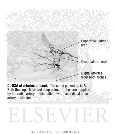 Digital Subtraction Angiography (DSA) of Arteries of Hand