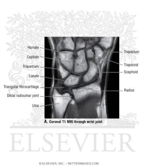 Coronal T1 MRI Through Wrist Joint