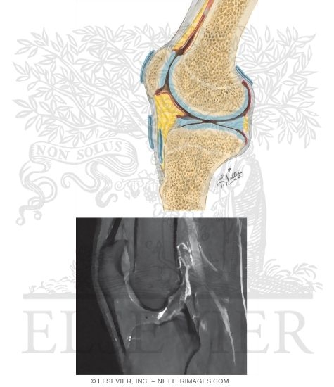 Sagittal Section of the Knee Joint and T2 MRI