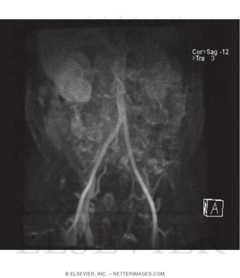 MRA With Maximum Intensity Projection (MIP)