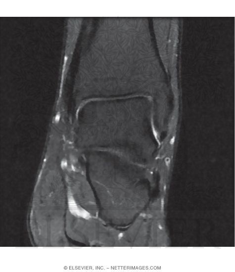 Coronal T2 MRI Through the Ankle Joint