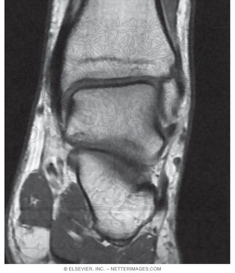 Coronal T1 MRI Through the Ankle Joint