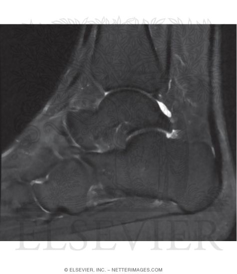 Sagittal T2 MRI Through the Ankle Joint