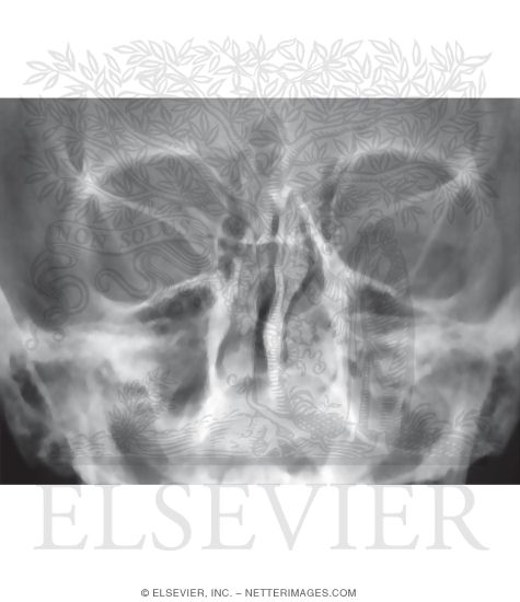 Anteroposterior X-Ray In a Caldwell Projection