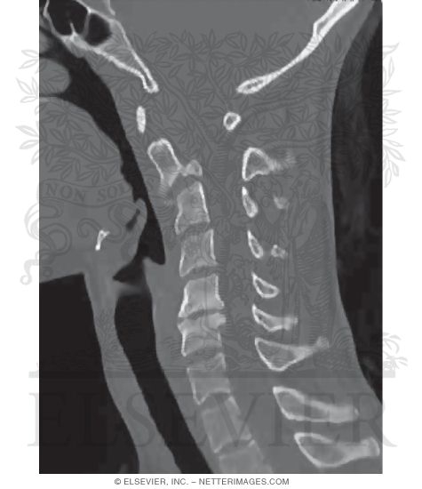 CT Sagittal Reconstruction With Bone Window Showing C2 Fracture ...