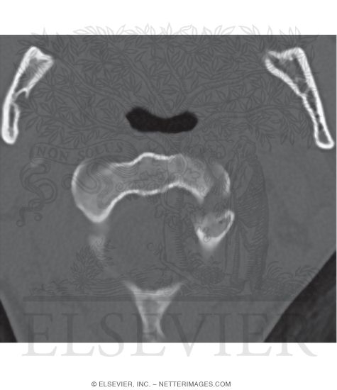 Axial CT Showing C2 Fracture